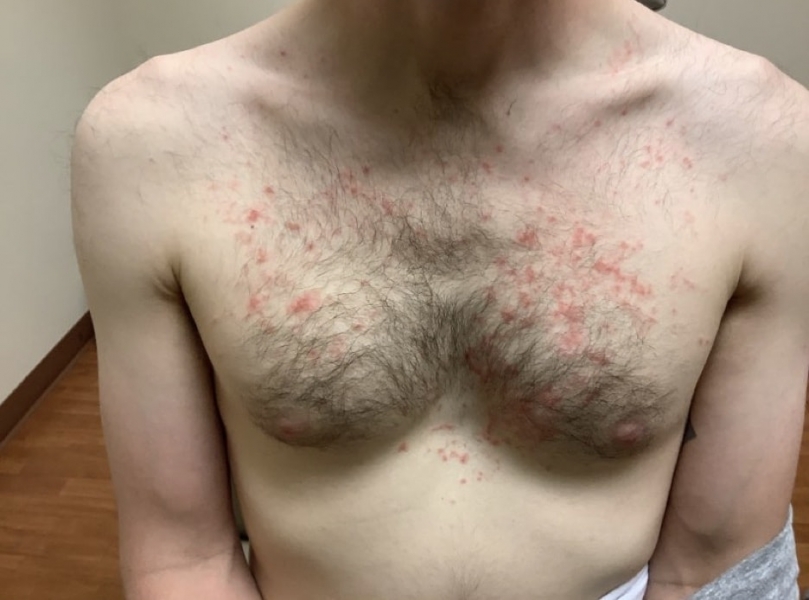 A 30+ year old man was seen for a chief complaint of itchy, raised, red ...