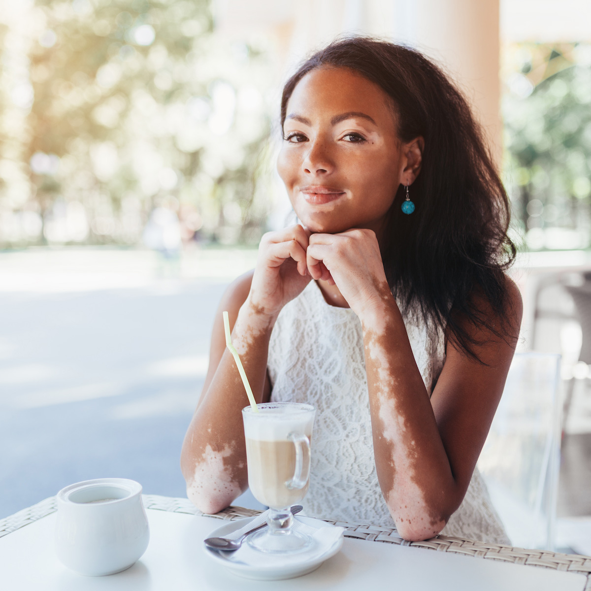 Vitiligo 101 Forefront Dermatology