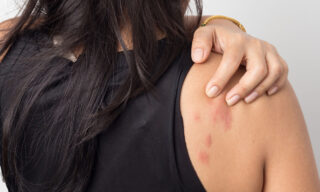 Dermatology Blog Archives | Forefront Dermatology